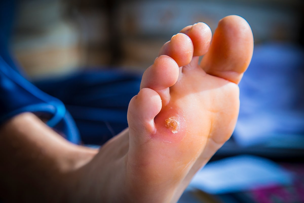 Hammertoes in Naperville, IL | Illinois Podiatry Specialists